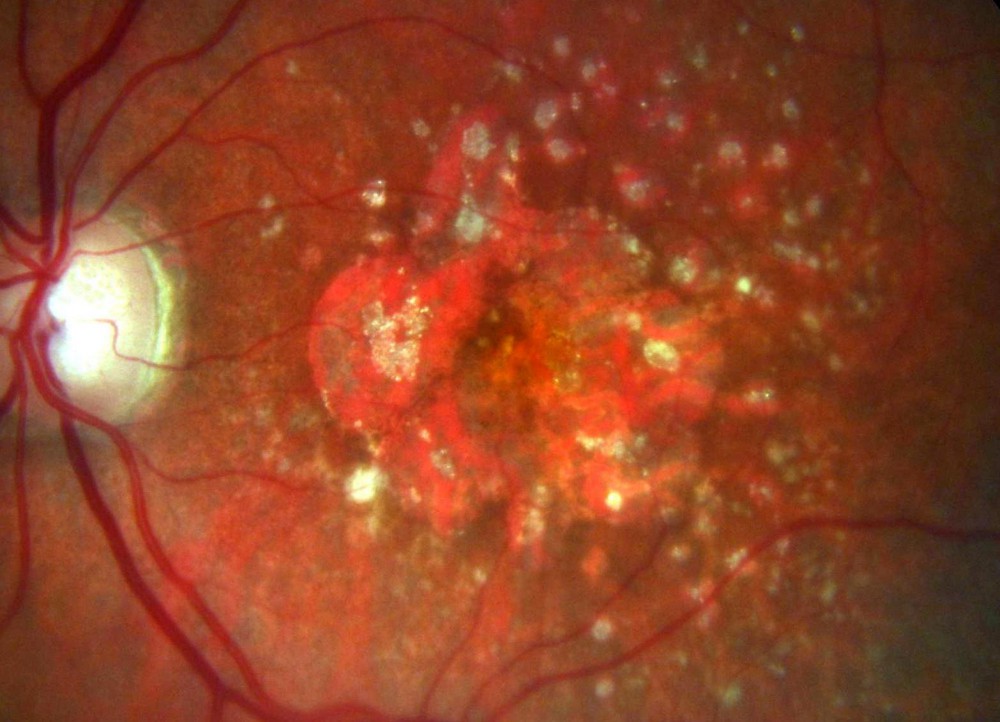Pathologies de la Rétine - Centre Ophtalmologique Dijon Toison d'or ...